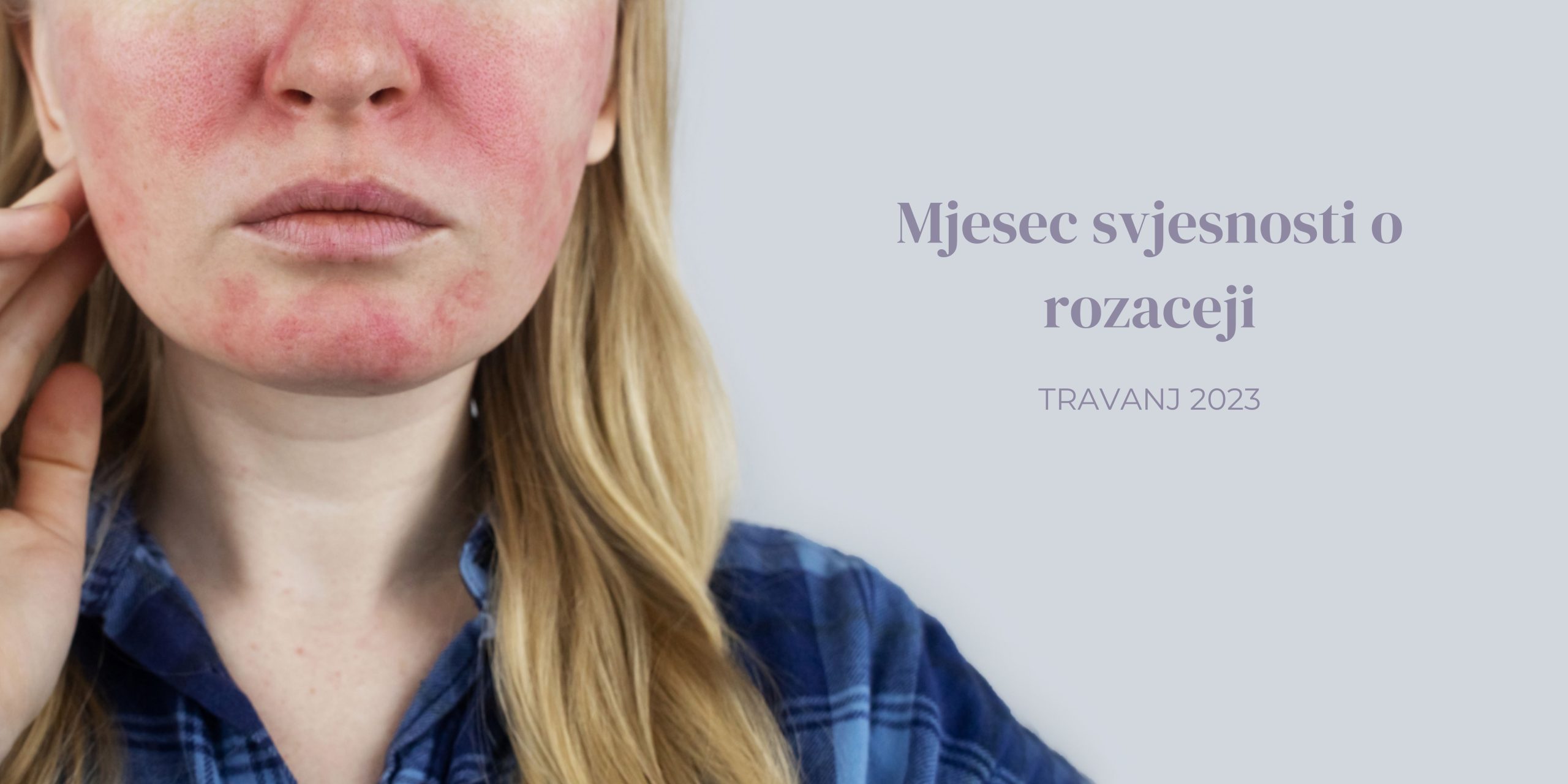 Rozacea 101 - Rosalique